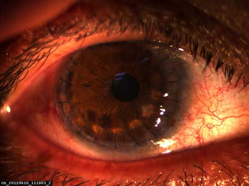 Cornea Transplant - Dr. Salouti Medical Clinic